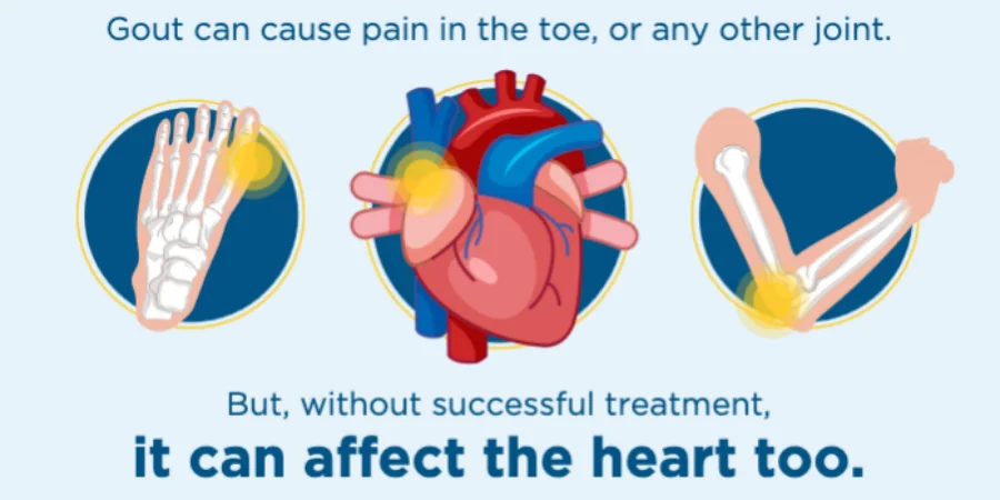 Infographics - Alliance for Gout Awareness